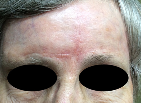 Denver Mohs Surgeon and Mohs Surgery in Denver - Colorado Dermatology ...